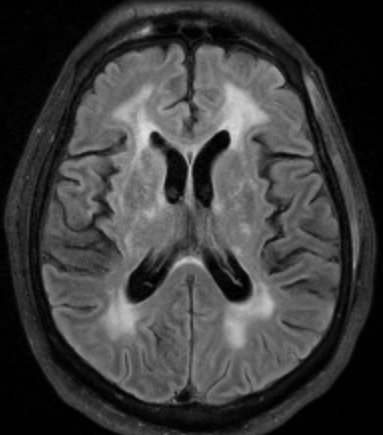 Enlarged perivascular spaces seen on MRIs predict cognitive performance ...