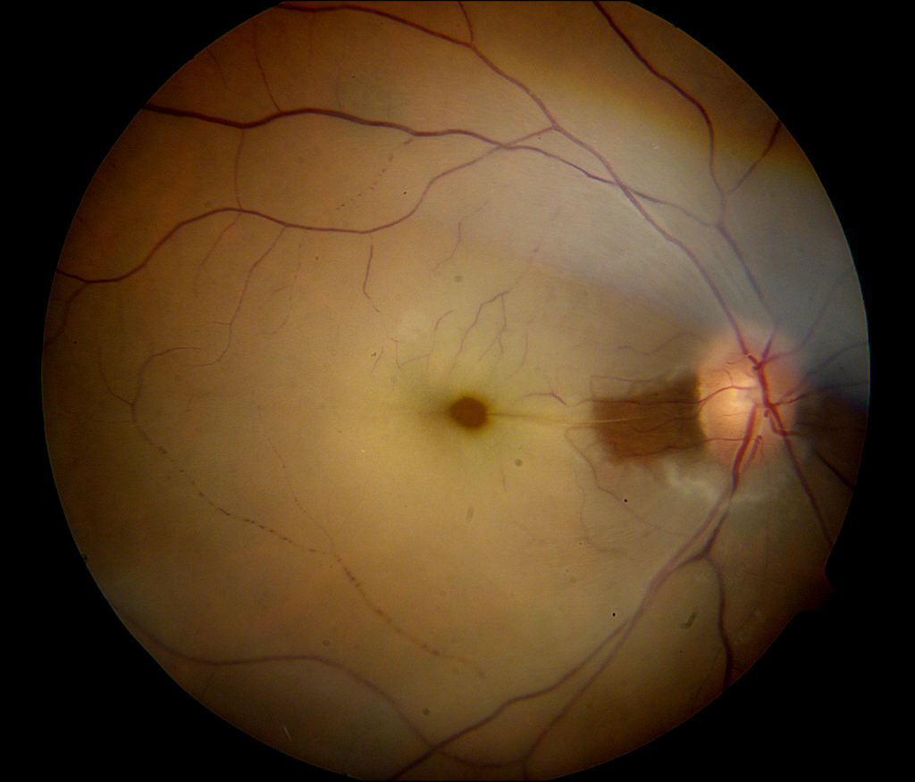 Trends in CRAO Management / Journal of Neurology - Schrag Laboratory